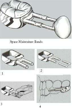 Band Space Maintainer Kit – Prestige Dental Products